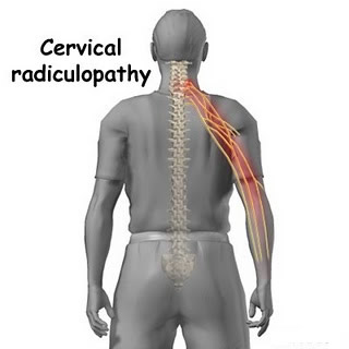 Radiculopathy - Causes - Symptoms - Diagnosis and treatment